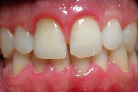 What Is Dental Plaque And How To Remove From Teeth