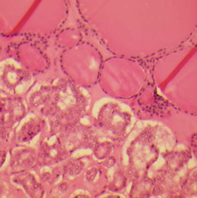 Lingual Thyroid Nodule
