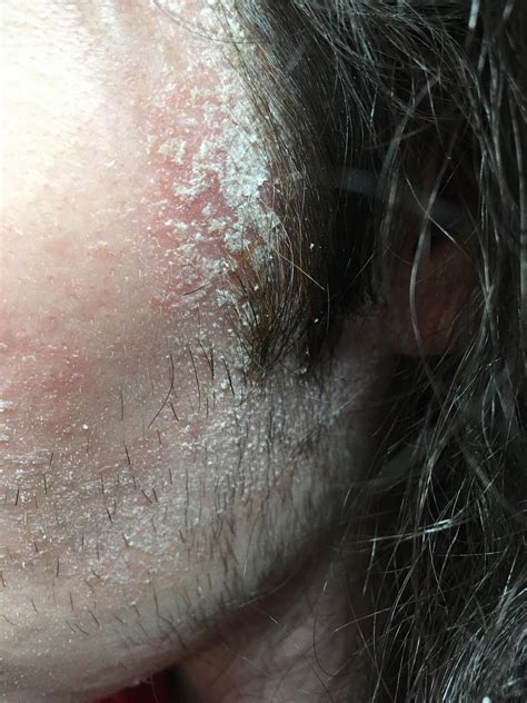 Dupixent Side Effects Eye Inflammation Getting Unbearable R Eczema