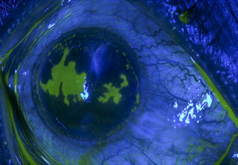 Diagnosing Microbial Keratitis In Different Settings Community Eye