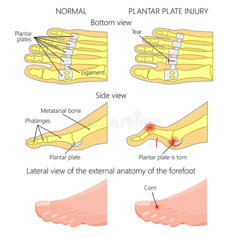 I Think I Have A Plantar Plate Tear Plantar Health