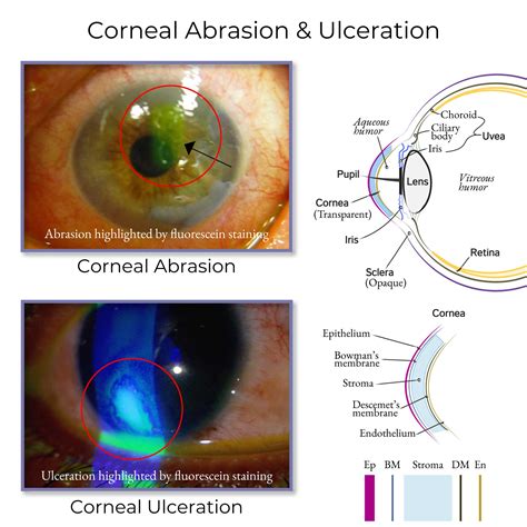 Corneal Ulcer Vs Abrasion