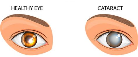 GitHub Piygot Cataract Detection And Classification This Project Aim To A Build System Which
