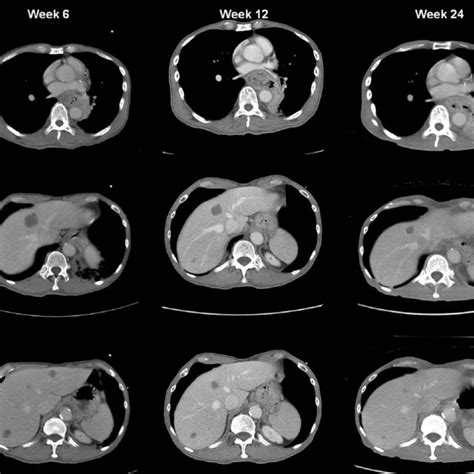 Computed Tomography Scan Of Esophageal A Hepatic B And Lymph Node Download Scientific