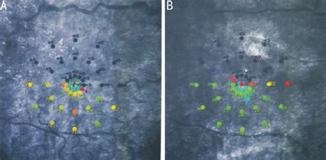 Macular Sensitivity Map Of The Right Eye Of The 12 Year Old Female