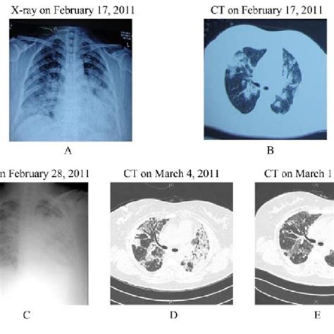 Chest X Ray And Computed Tomographies Of Case 1 Download Scientific Diagram