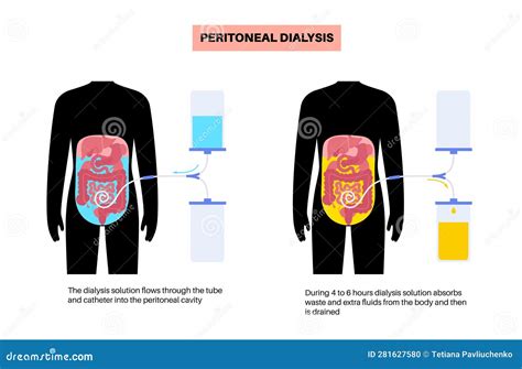 Abdominal Paracentesis Poster Vector Illustration 282196450
