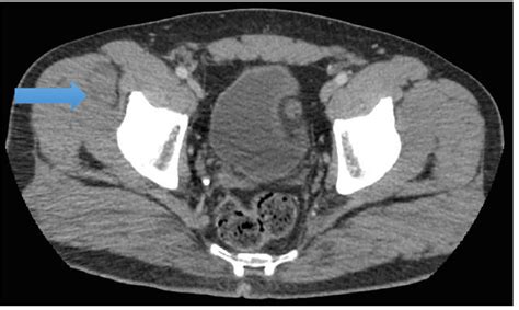 Ct Abdomenpelvis Showing Soft Tissue Mass Involvement At The Level Of