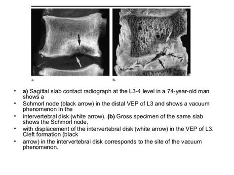 Schmorls Nodes Spine 2010