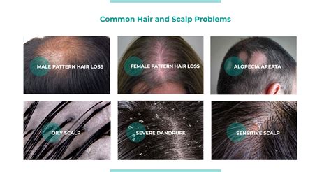 Hair And Scalp Disorders At Aidan Zichy Woinarski Blog