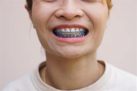 Premium Photo Asian Woman Smiling Showing Braces