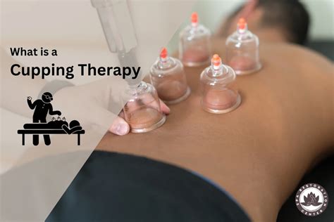 What Is Cupping Therapy