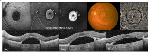 Initial Presentation 2005 Shows A Large Rpe Atrophy On Color Fundus