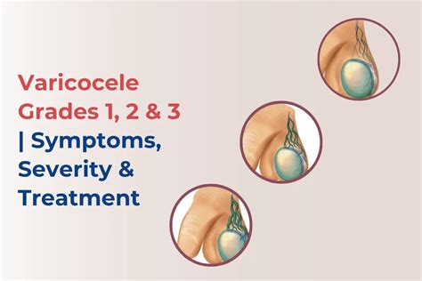 Varicocele Grades 1 2 And 3 Symptoms Severity And Treatment
