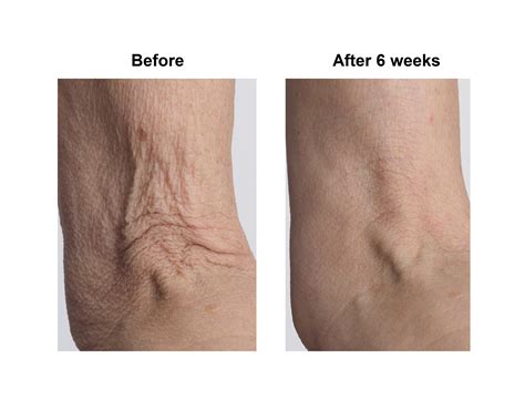Protein For Crepey Skin How To Get Rid Of Crepey Skin