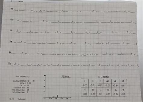 A Flutter Vs Svt Rekgs