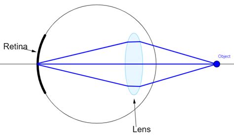 Distinguish Between Myopia And Hypermetropia
