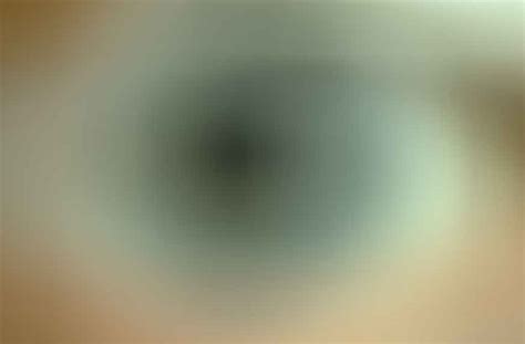 Scleral Lenses Advanced Treatment For Lattice Corneal Dystrophy