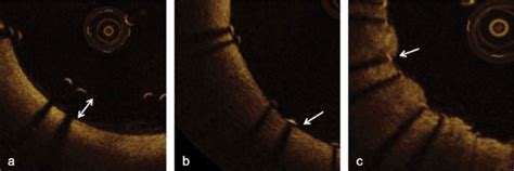 Classification Of Stent Strut Apposition The Distance Between Download Scientific Diagram