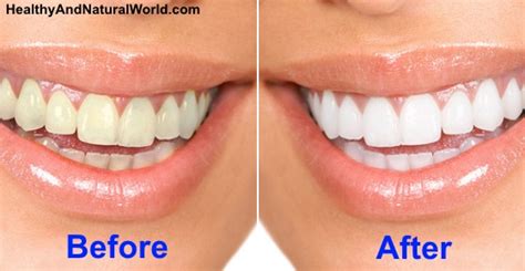 Naturally Whiten Your Teeth In 3 Minutes At Home Research Based