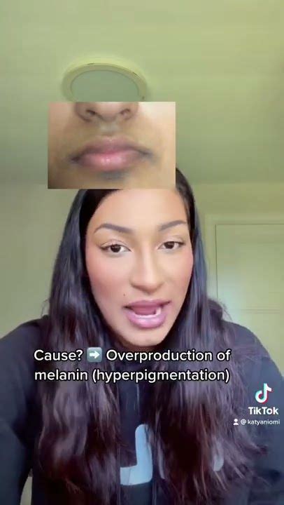 Get Rid Of Hyperpigmentation Around Lips Hyperpigmentation Dark Skin