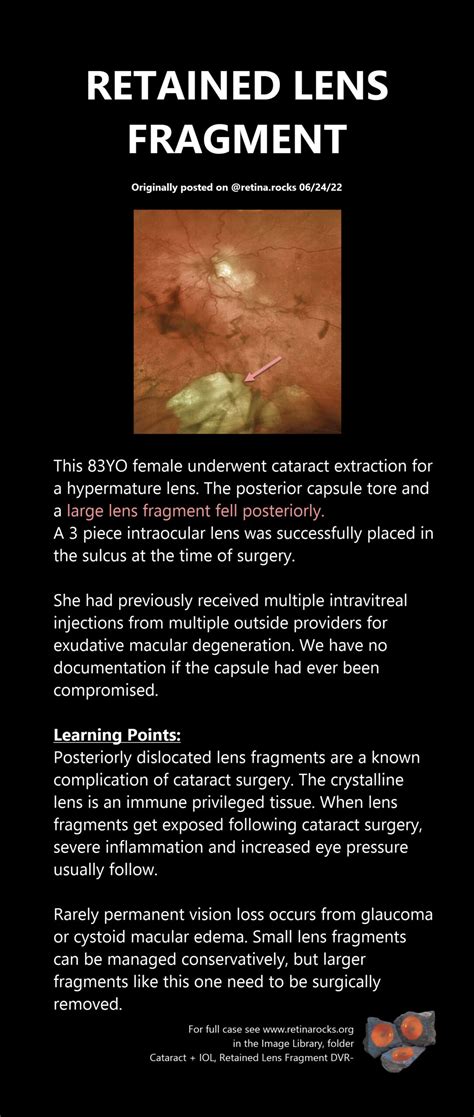 Miscellaneous Cataract Dislocated Iol Retained Lens Fragments