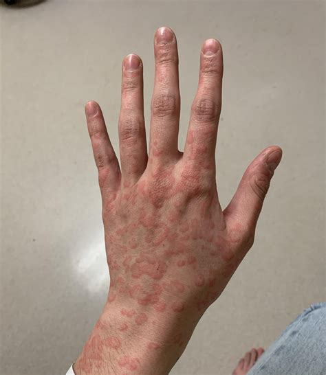 Cholinergic Urticaria Urticarial Vasculitis I Saw A Derm Who Said It