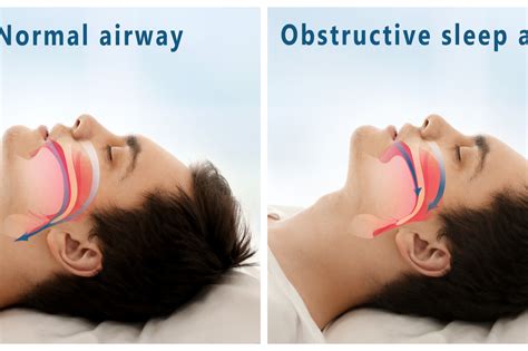 Obstructive Sleep Apnea Icd MN Heart