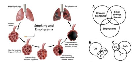 Copd Flashcards Quizlet