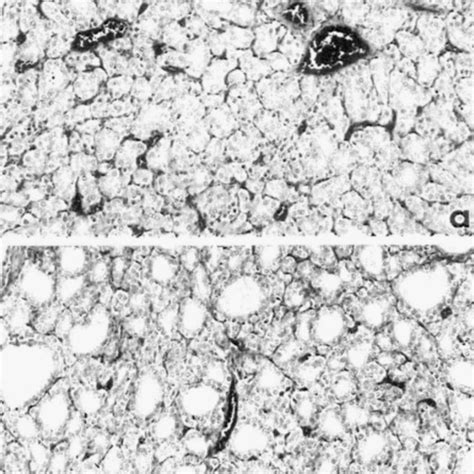 A Light Micrograph Illustrating Diffuse Hyperplasia Of The Thyroid