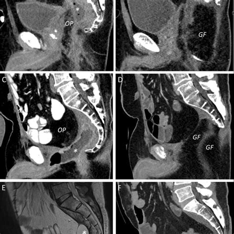 Pre And Postoperative Sagittal Pelvic Imaging Using Ct Ad F Or Mri Download Scientific