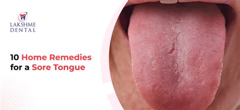 10 Home Remedies For A Sore Tongue