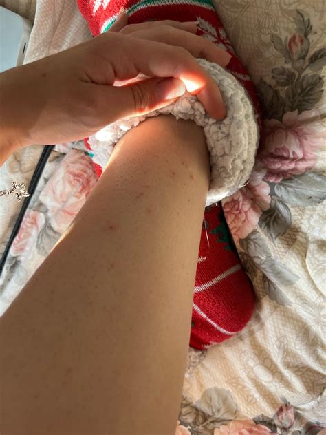 Skinconcern Folliculitis Papular Eczema Rskincareaddicts