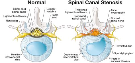 Foraminal Stenosis Uk