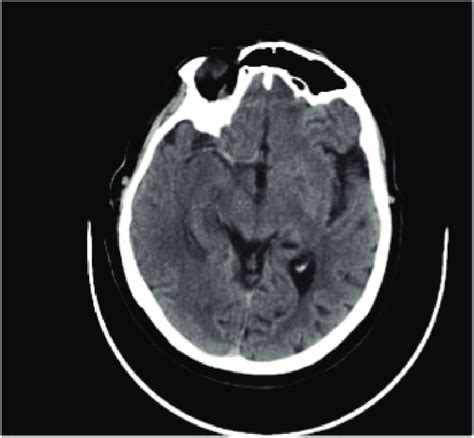 The Brain Ct Shows A Hyperdense Right Middle Cerebral Artery In The Download Scientific Diagram