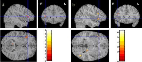 Activation In The Right Inferior Frontal Gyrus P