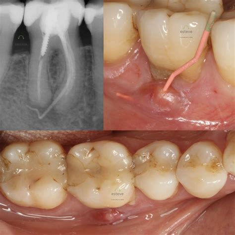 Draining Fistula Dental Signs Of Tooth Abscess Stages And Treatments