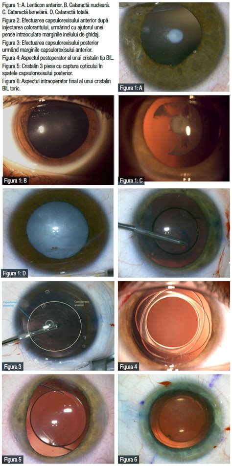 Tratamentul Actual Al Cataractei Congenitale Medical Market