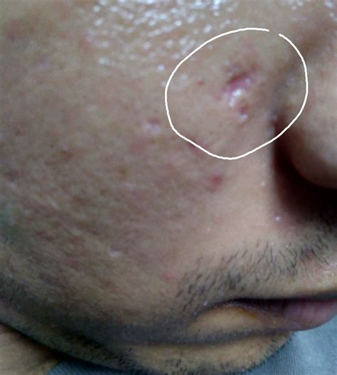 Chicken Pox Scars Treatment