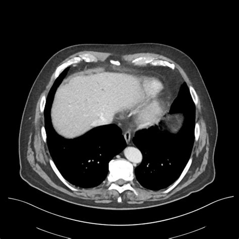 Extrahepatic Cholangiocarcinoma Image