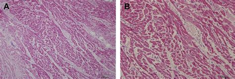 Cardiac Biopsy Shows Interstitial Myocardial Edema With Focal Disarray
