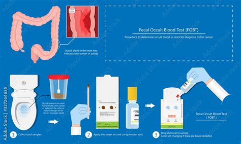 Stool Examination Occult Blood Absent Means At Michele Fields Blog