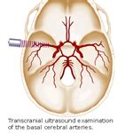 Desonics Inc Transcranial Doppler Testing