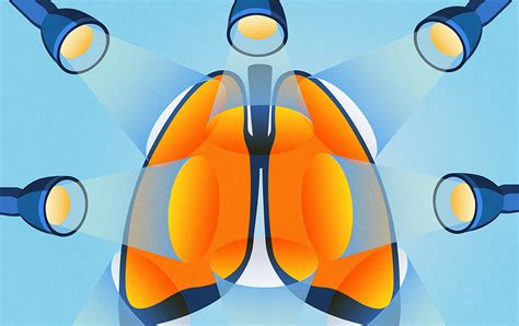New Lung Cancer Screening Program Aims To Increase Access Cedars Sinai