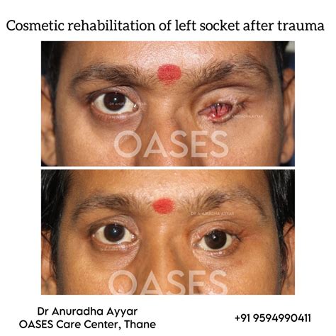 How I Healed A Young Man With Socket Surgery Dr Anuradha Ayyar Posted On The Topic Linkedin