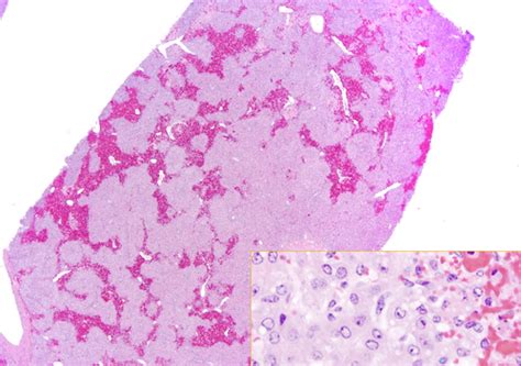 Hepatic Disease II Inflammatory Infectious Flashcards Quizlet