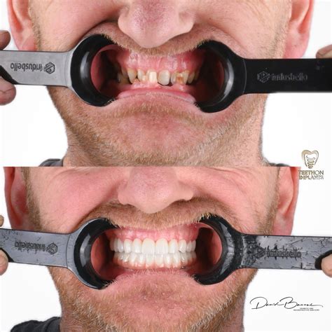 Transformations By Teeth On Implants Teeth On Implants