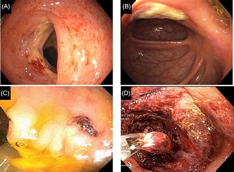 Inflammatory Bowel Disease Like Conditions Ischemic Bowel Diseases And Vasculitides Clinical Tree