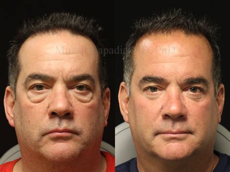 Eyelid Surgery And Blepharoplasty Boston Eyelid Surgery