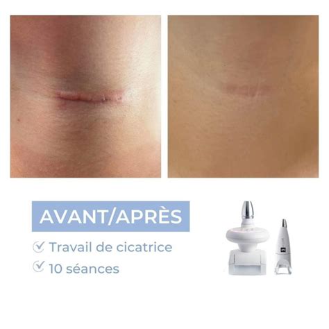 Lpg® Médical On Instagram Avantaprès Un Travail De Cicatrice Après